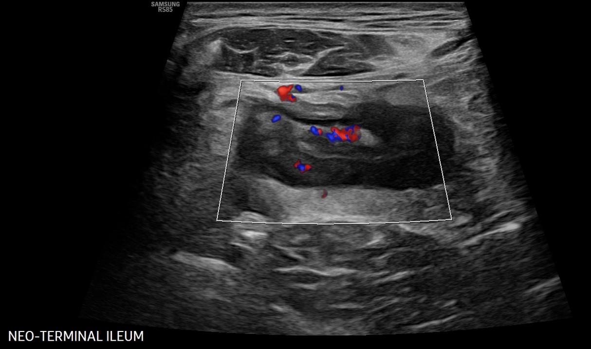 Intestinal Ultrasound: How IBD Patients Can Help Fuel Its Adoption in ...